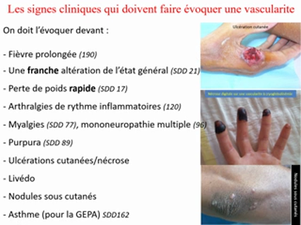 UAPod - Vascularites